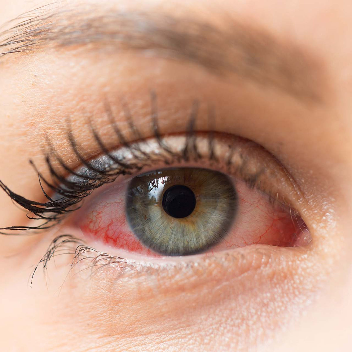 Eye Allergies: Symptoms, Causes, and Treatment - Allermi