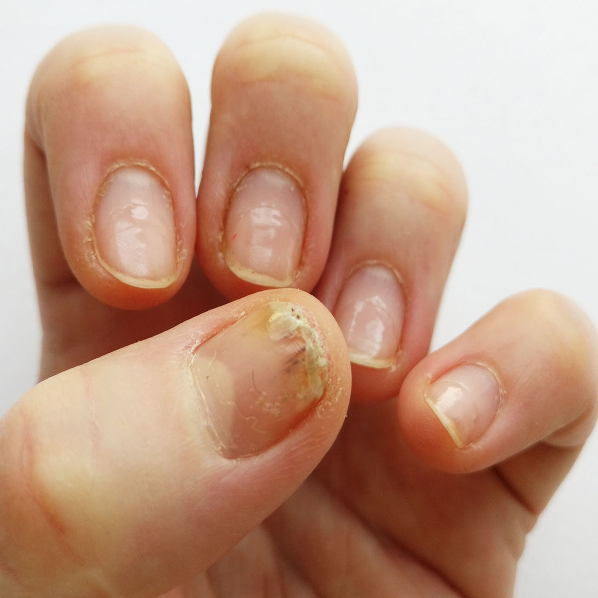 Gel Nail Allergy: Treatment and Prevention - Allermi